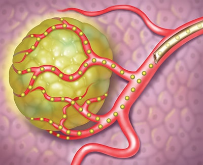 Highlights from the phase III EPOCH trial - Colorectal Cancer Canada